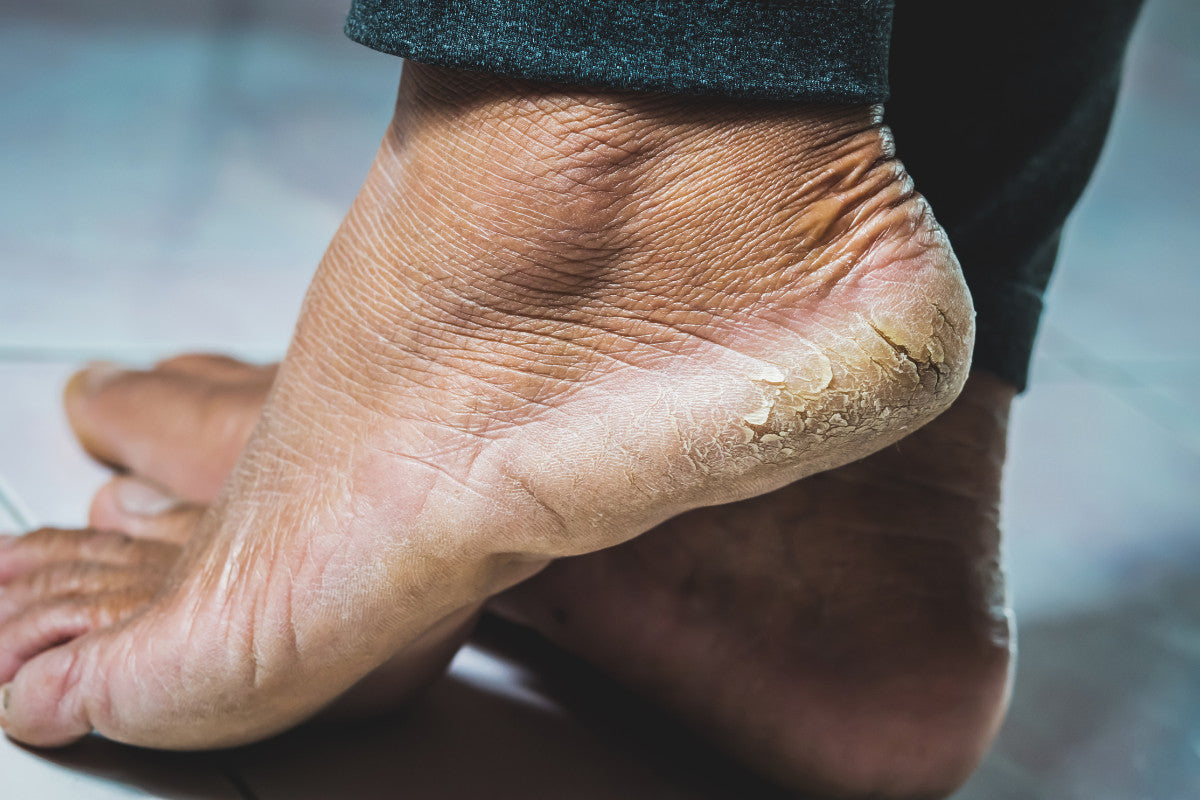 Common Foot Issues and How to Fix Them – Noche Skincare